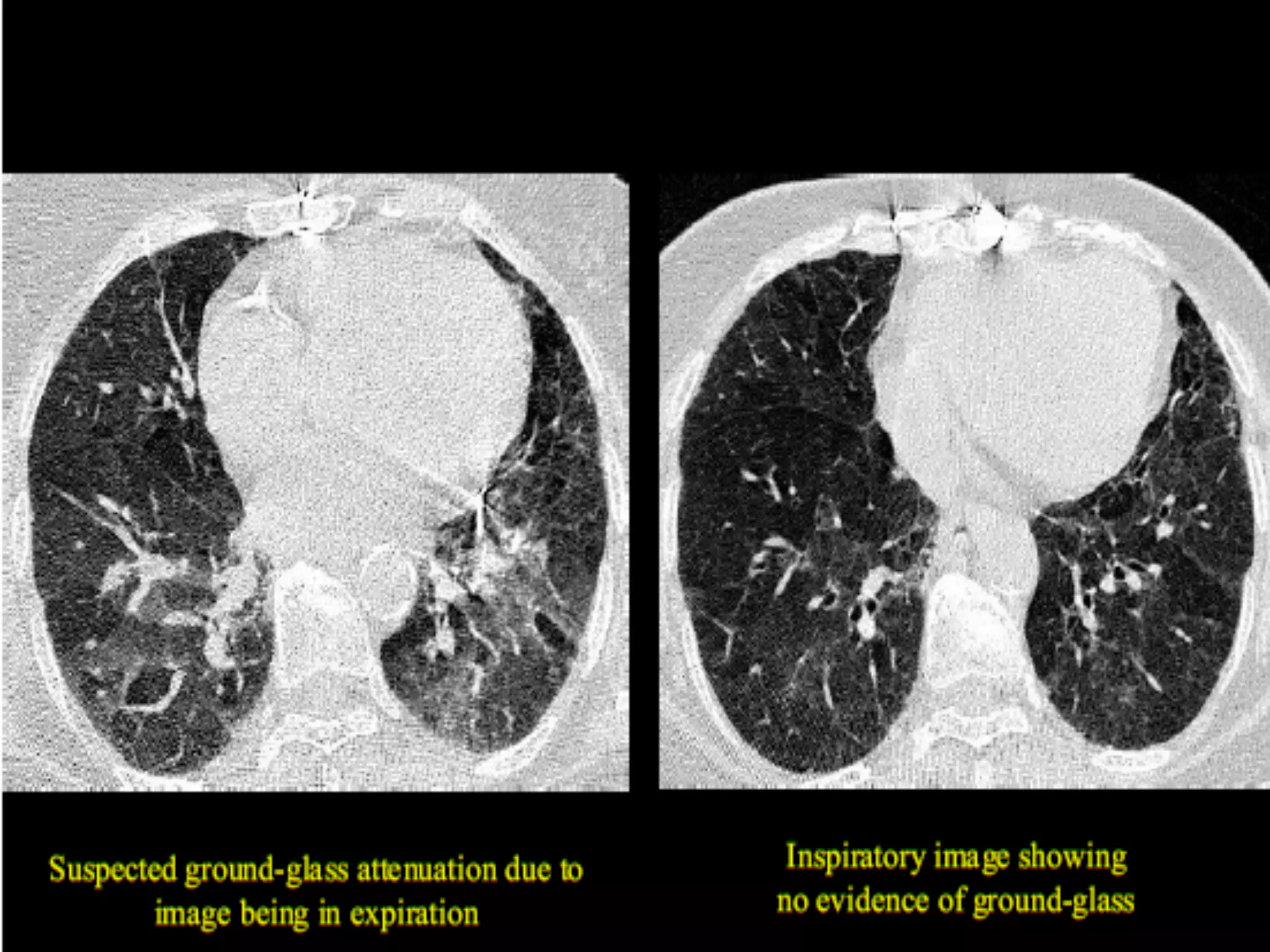 HRCT TECHNIQUE AND INTERPRETATION | PDF