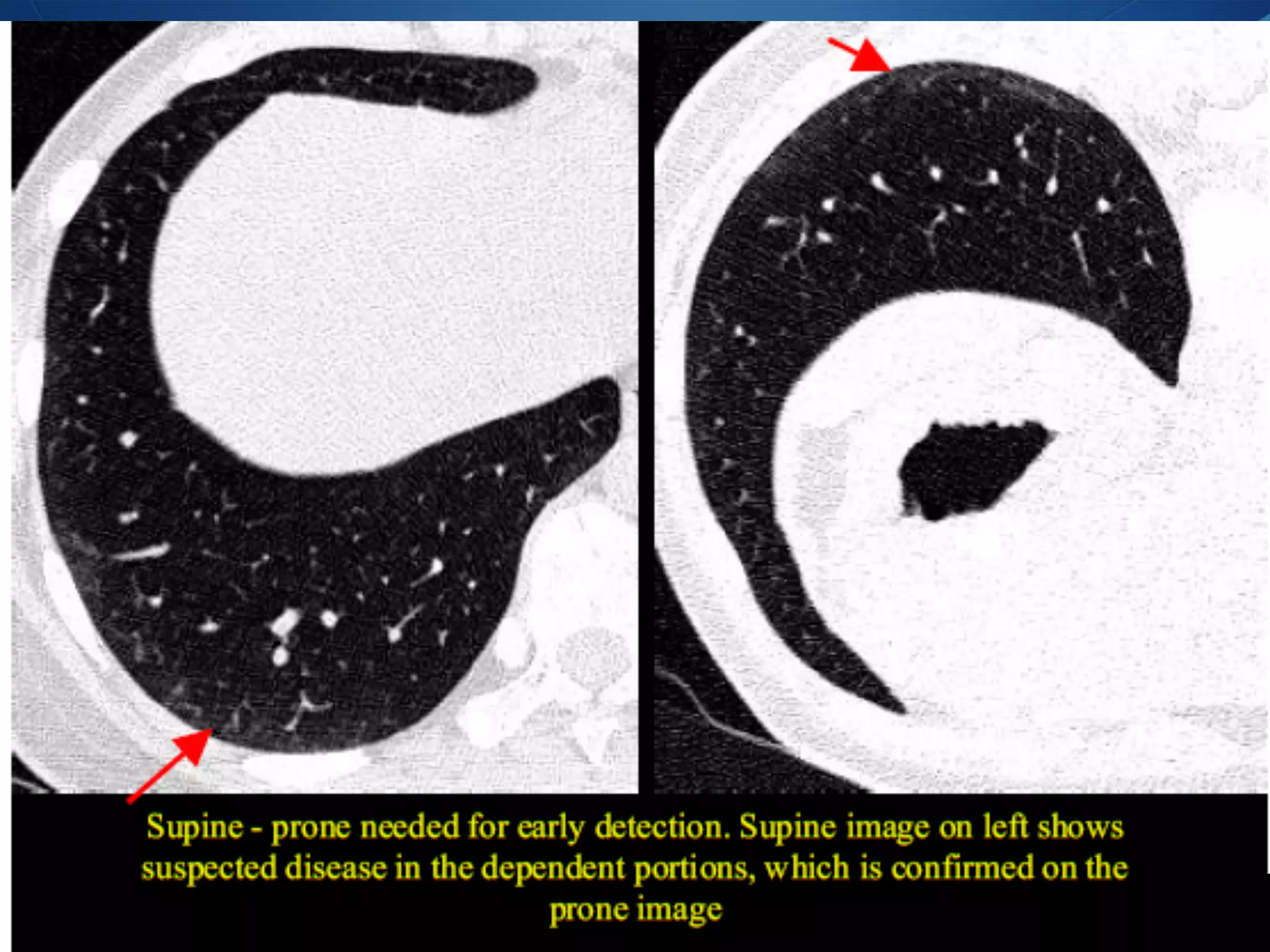 HRCT TECHNIQUE AND INTERPRETATION | PDF