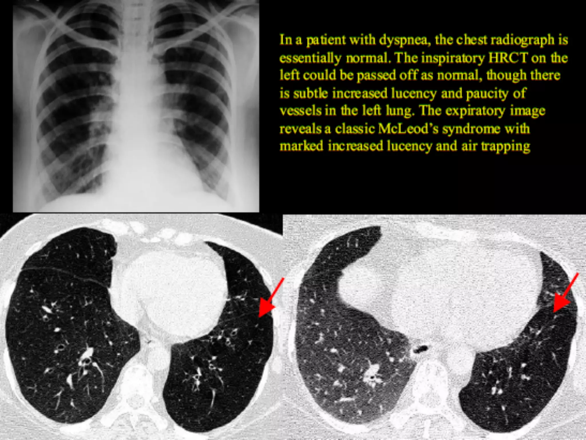 HRCT TECHNIQUE AND INTERPRETATION | PDF