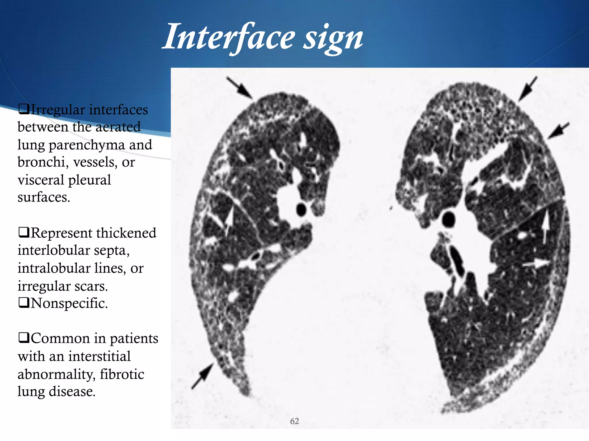 HRCT TECHNIQUE AND INTERPRETATION | PDF