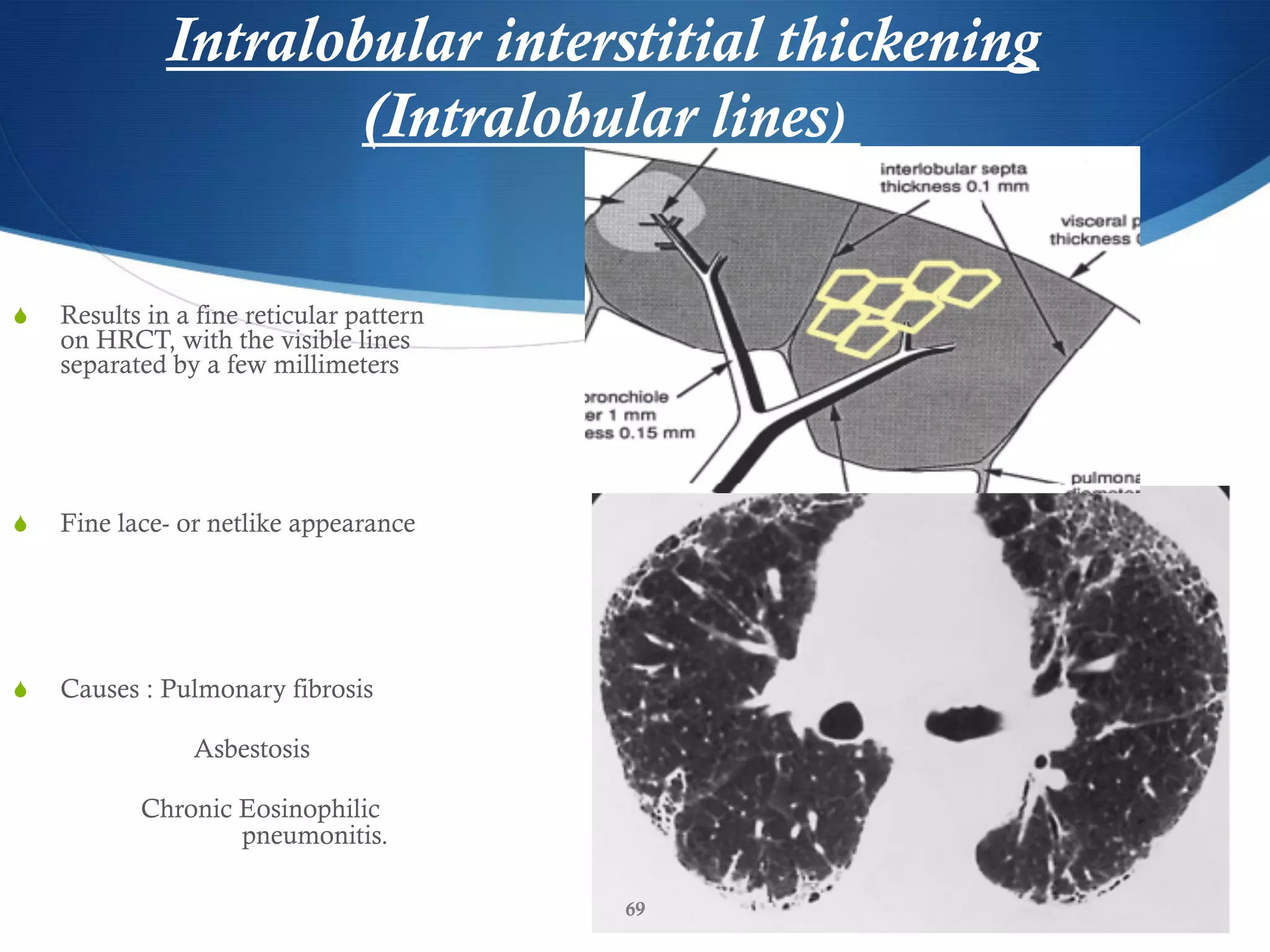 HRCT TECHNIQUE AND INTERPRETATION | PDF