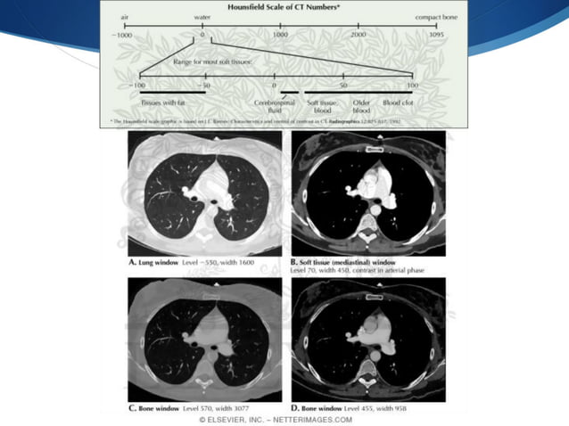 HRCT TECHNIQUE AND INTERPRETATION | PDF