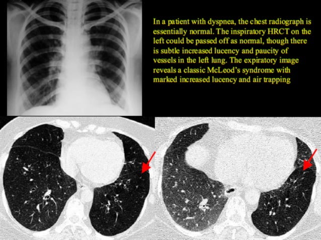 HRCT TECHNIQUE AND INTERPRETATION | PDF