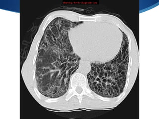 HRCT TECHNIQUE AND INTERPRETATION | PDF