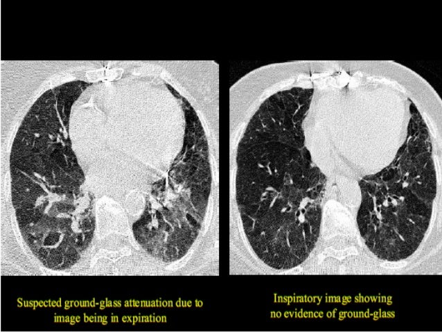 HRCT TECHNIQUE AND INTERPRETATION