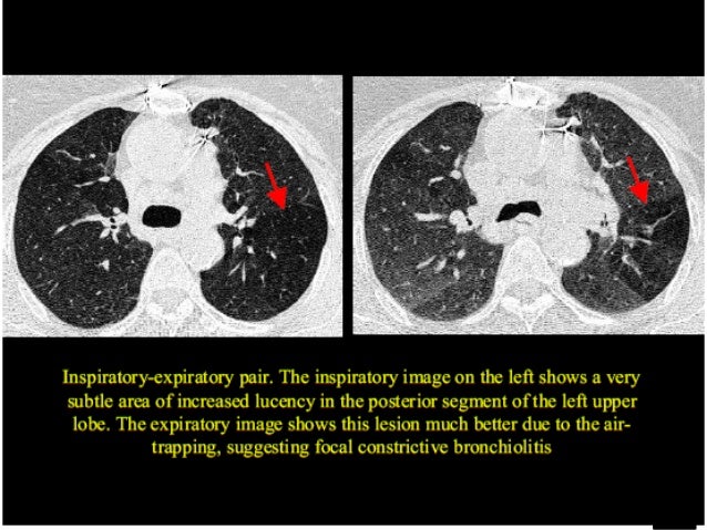 HRCT TECHNIQUE AND INTERPRETATION