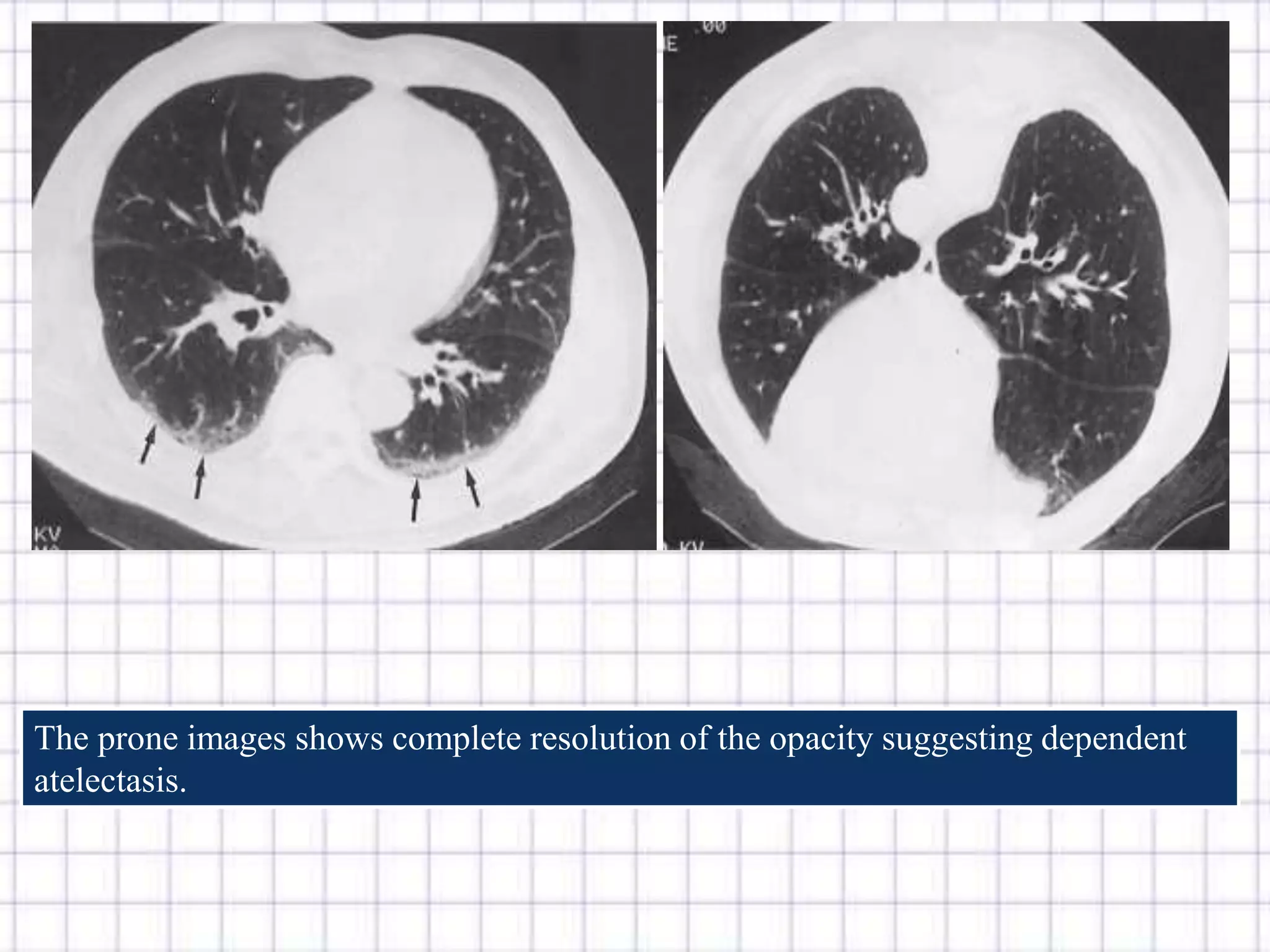 HRCT Chest - By Dr. Tinku Joseph | PPTX