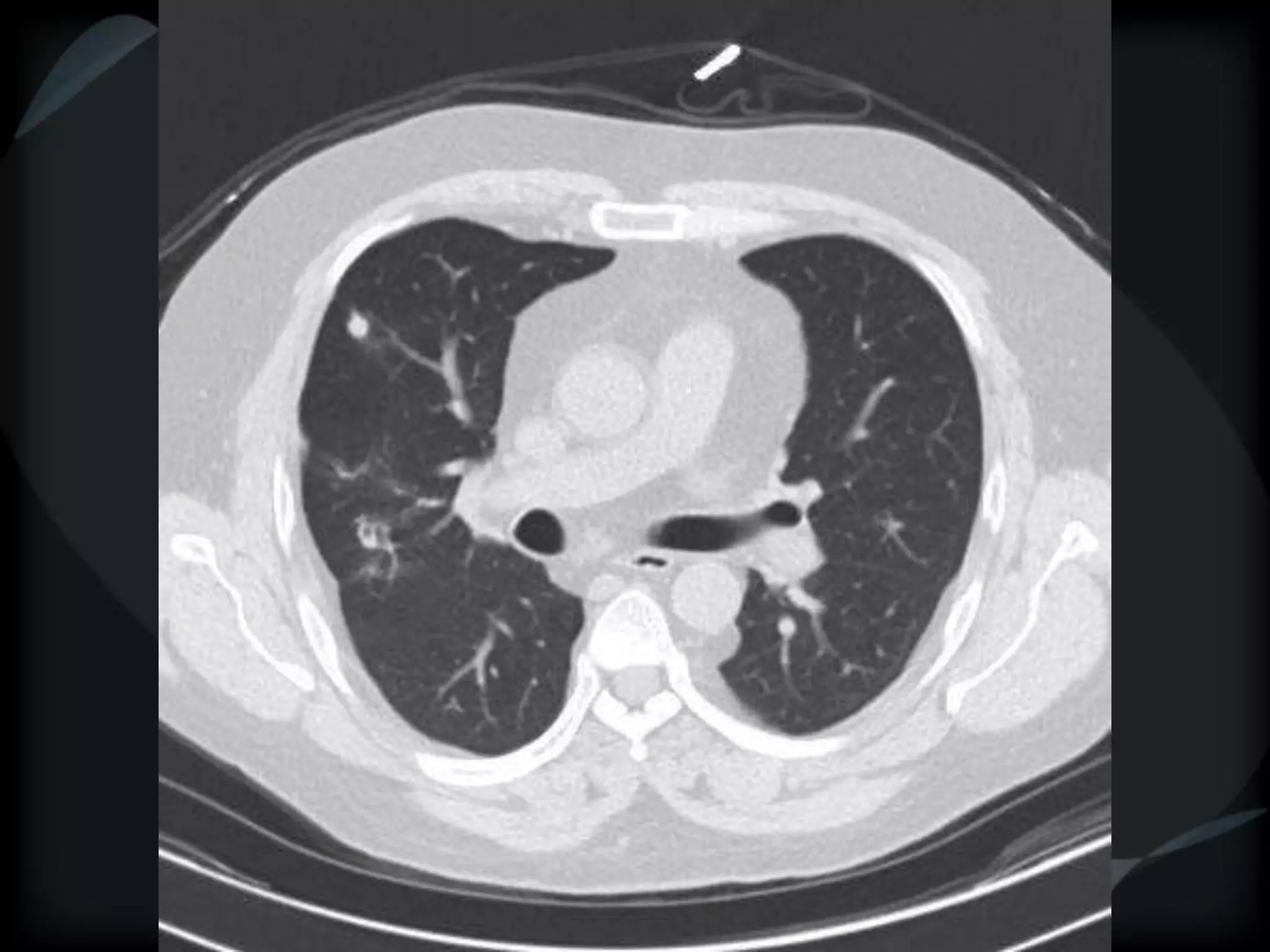 HRCT Interpretation | PPTX