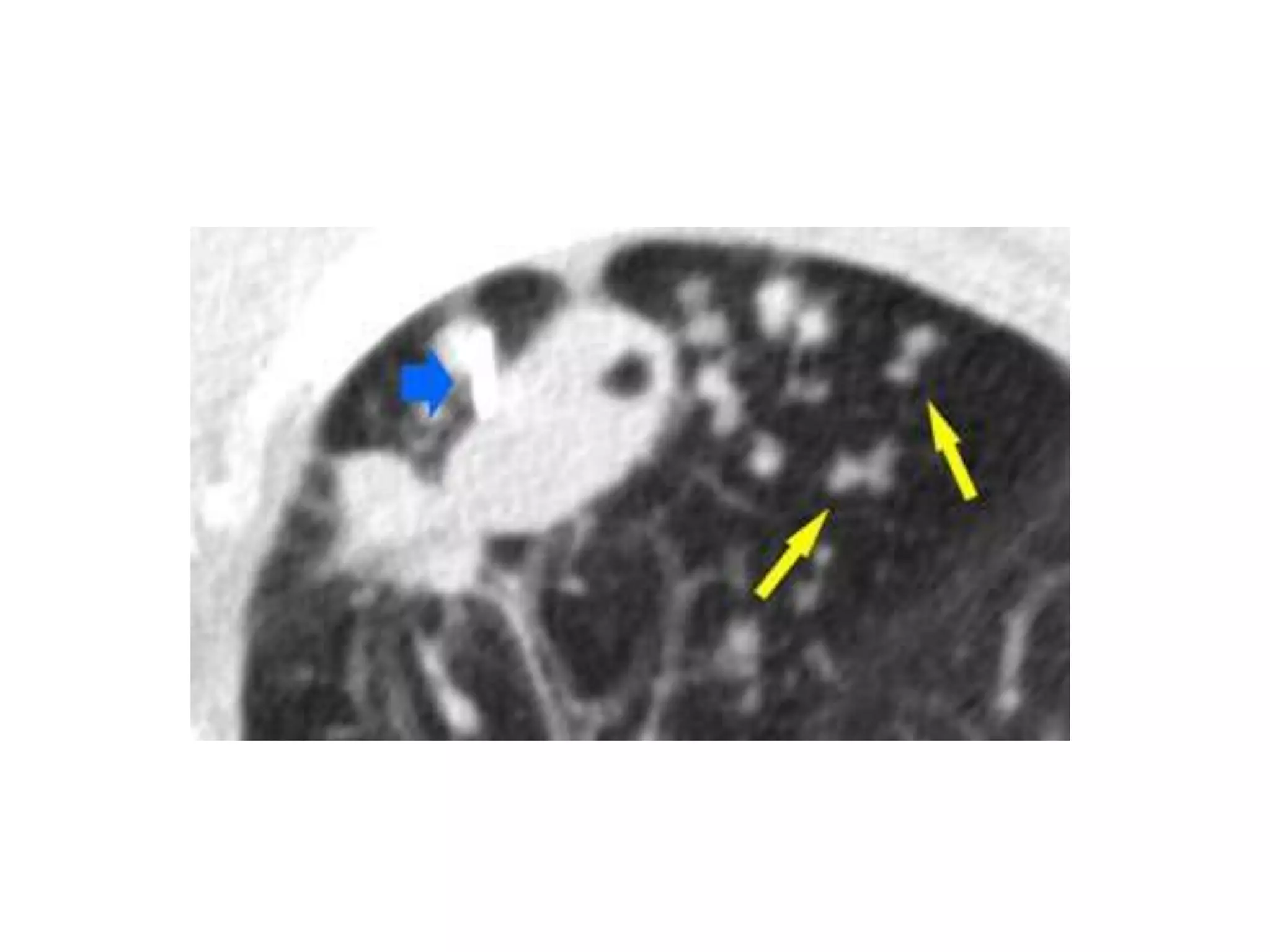 HRCT LUNG-BASIC INTERPRETATION | PPT