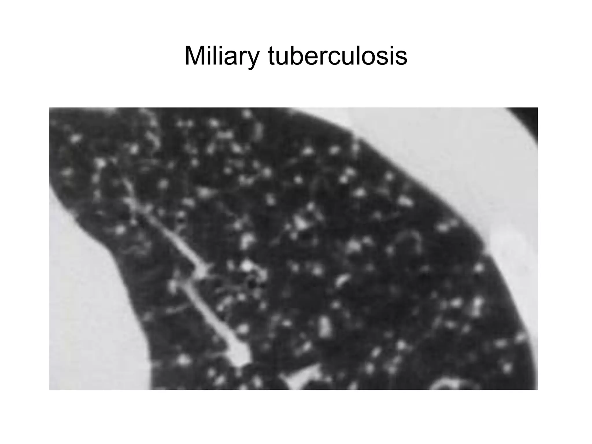 HRCT LUNG-BASIC INTERPRETATION | PPT