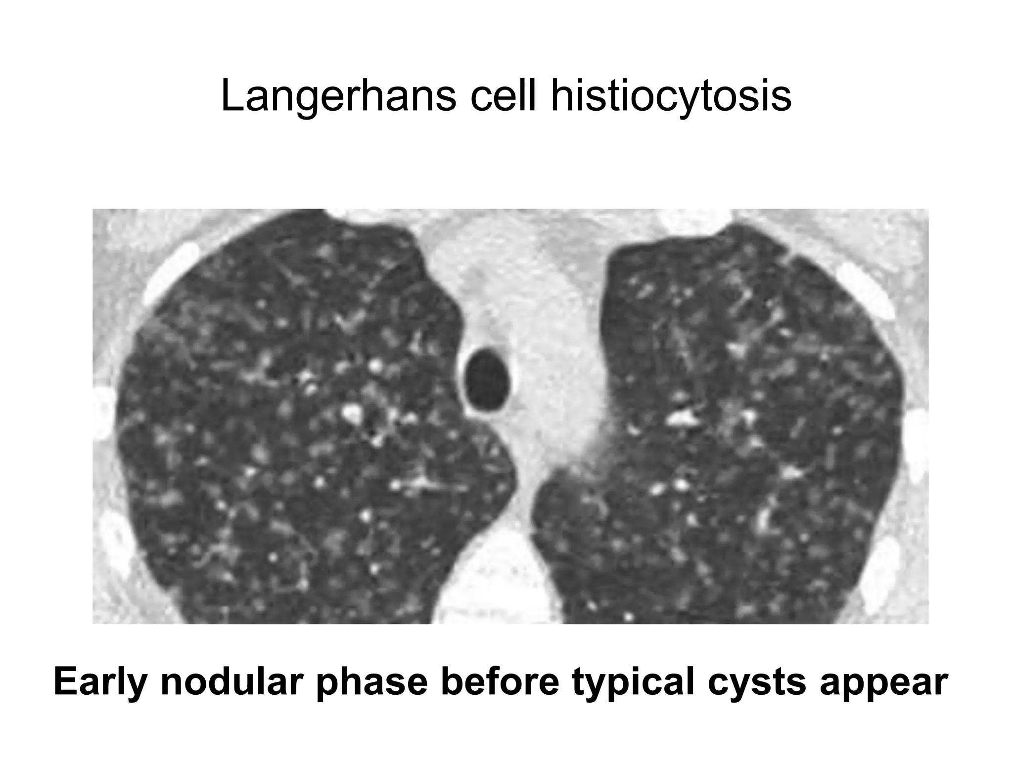 HRCT LUNG-BASIC INTERPRETATION | PPT