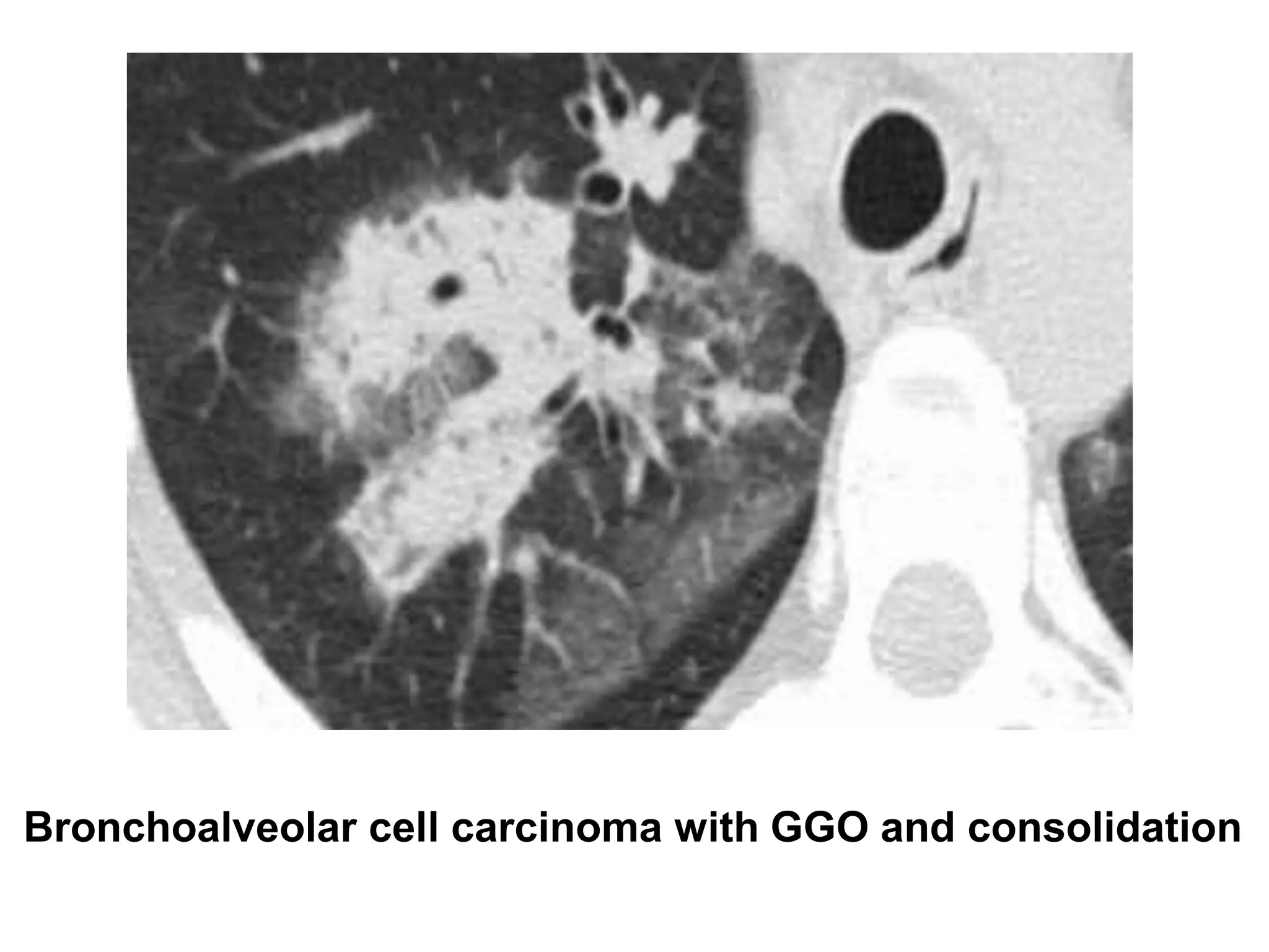 HRCT LUNG-BASIC INTERPRETATION | PPT