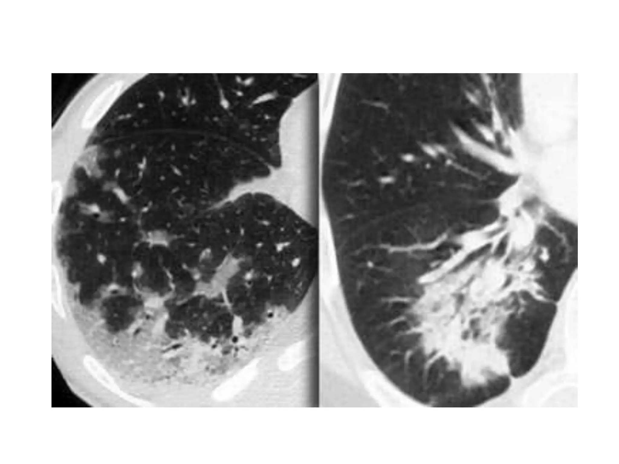 HRCT LUNG-BASIC INTERPRETATION | PPT | Lung and Respiratory Health ...