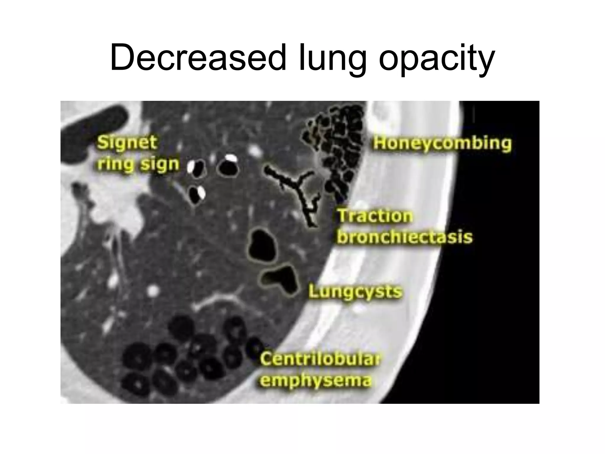 HRCT LUNG-BASIC INTERPRETATION | PPT