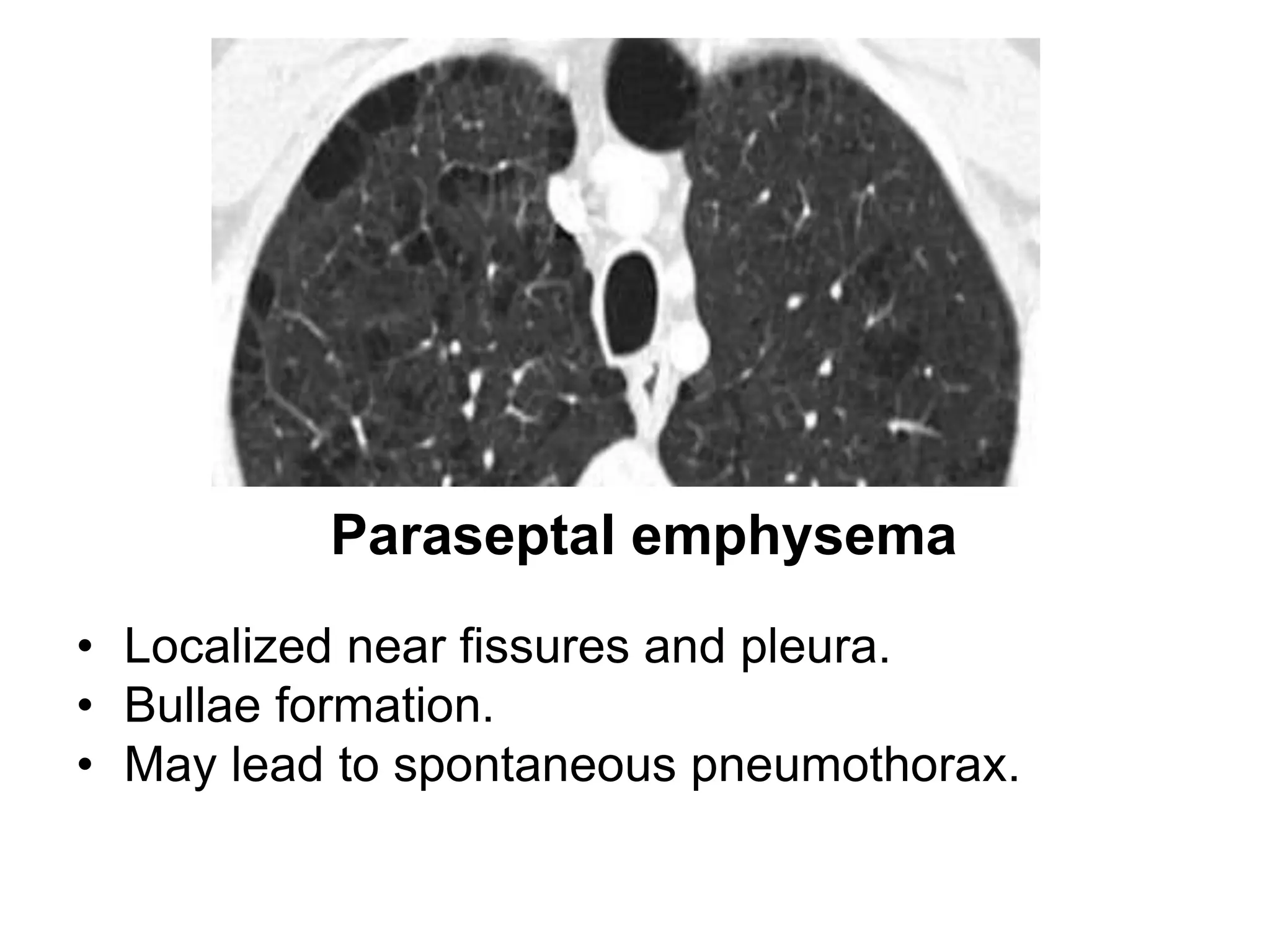 HRCT LUNG-BASIC INTERPRETATION | PPT