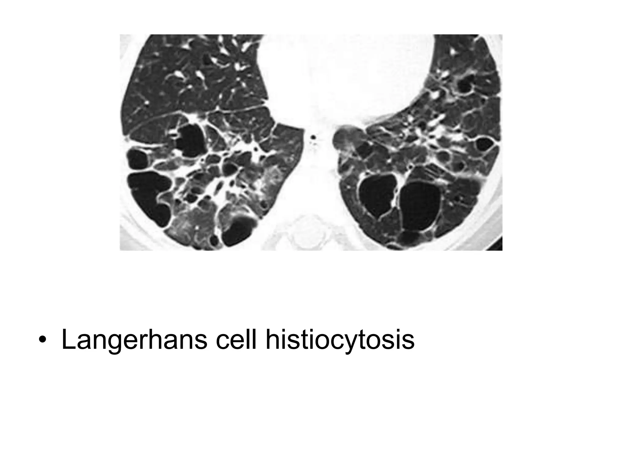 HRCT LUNG-BASIC INTERPRETATION | PPT