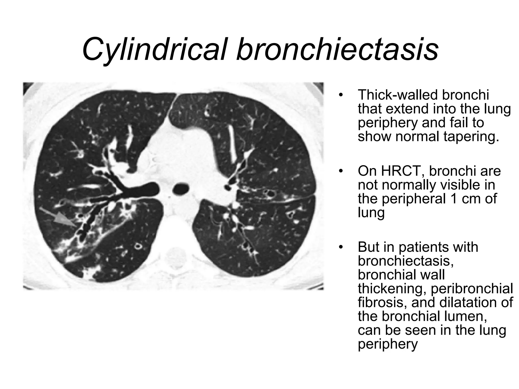 HRCT LUNG-BASIC INTERPRETATION | PPT