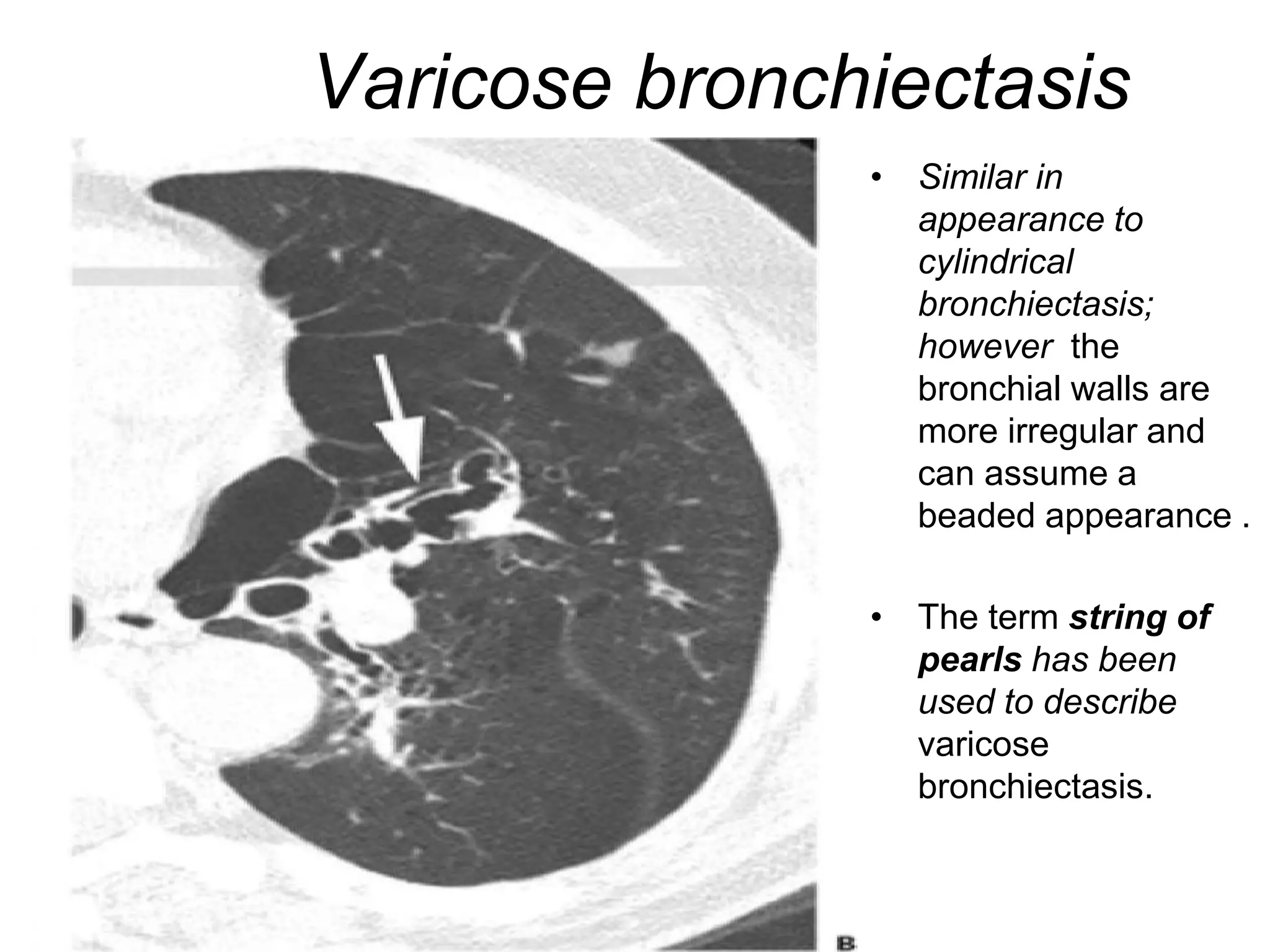 HRCT LUNG-BASIC INTERPRETATION | PPT
