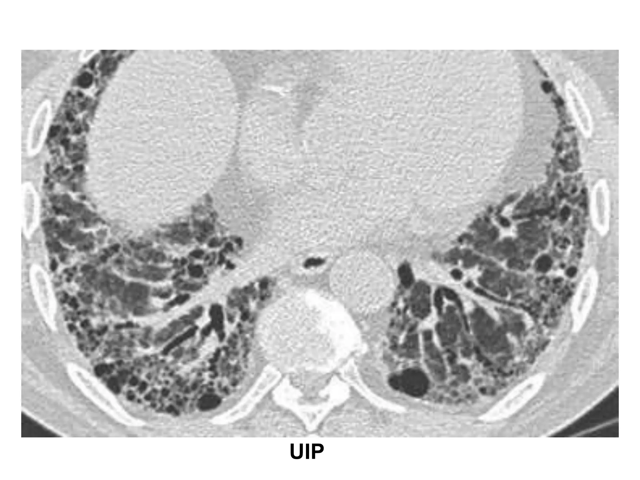 HRCT LUNG-BASIC INTERPRETATION | PPT | Lung and Respiratory Health ...