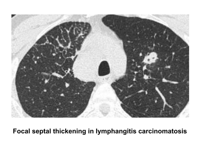 HRCT LUNG-BASIC INTERPRETATION | PPT | Lung and Respiratory Health | Diseases and Conditions