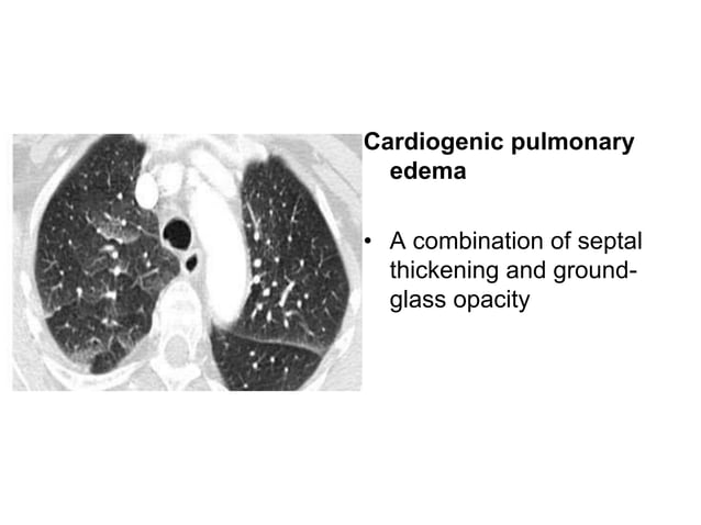 HRCT LUNG-BASIC INTERPRETATION | PPT | Lung and Respiratory Health ...