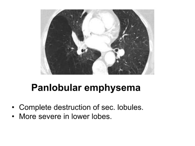 HRCT LUNG-BASIC INTERPRETATION | PPT | Lung and Respiratory Health ...