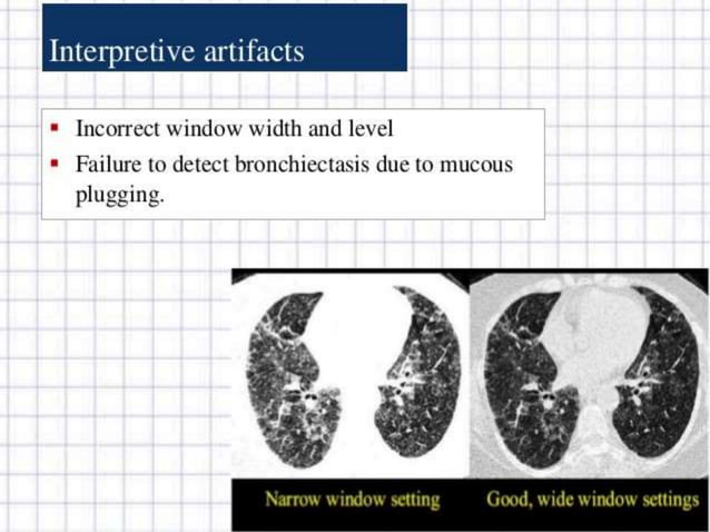 High resolution computer tomogtraphy.pptx