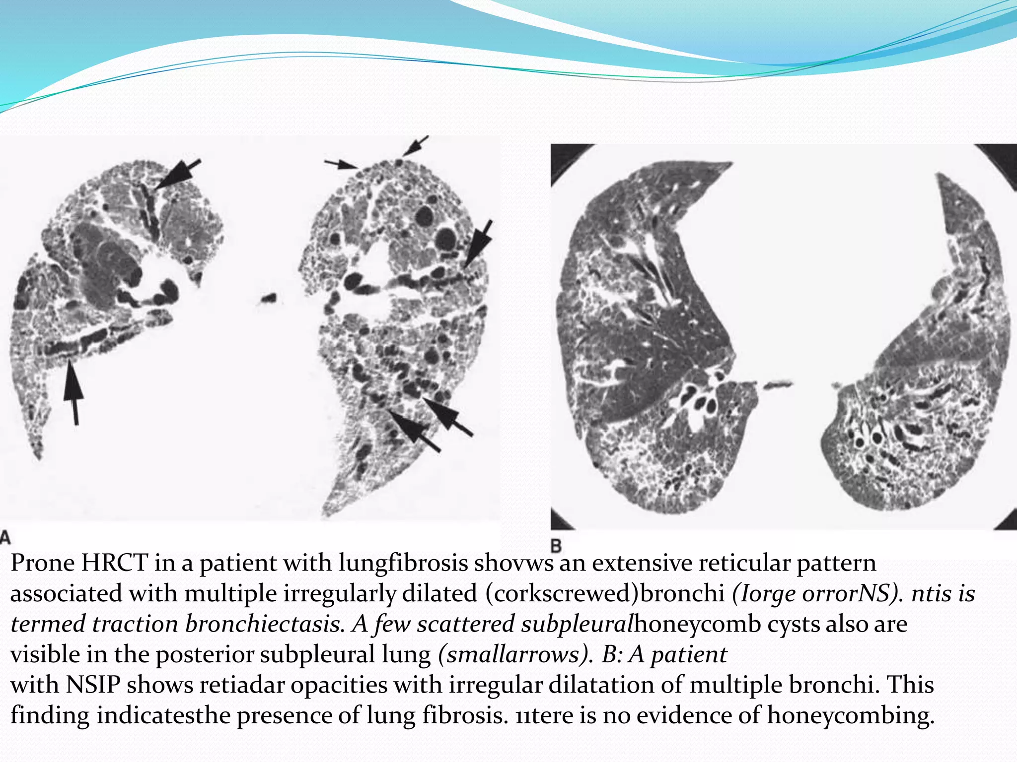 Hrct of idiopathic interstitial pneumonias | PPTX