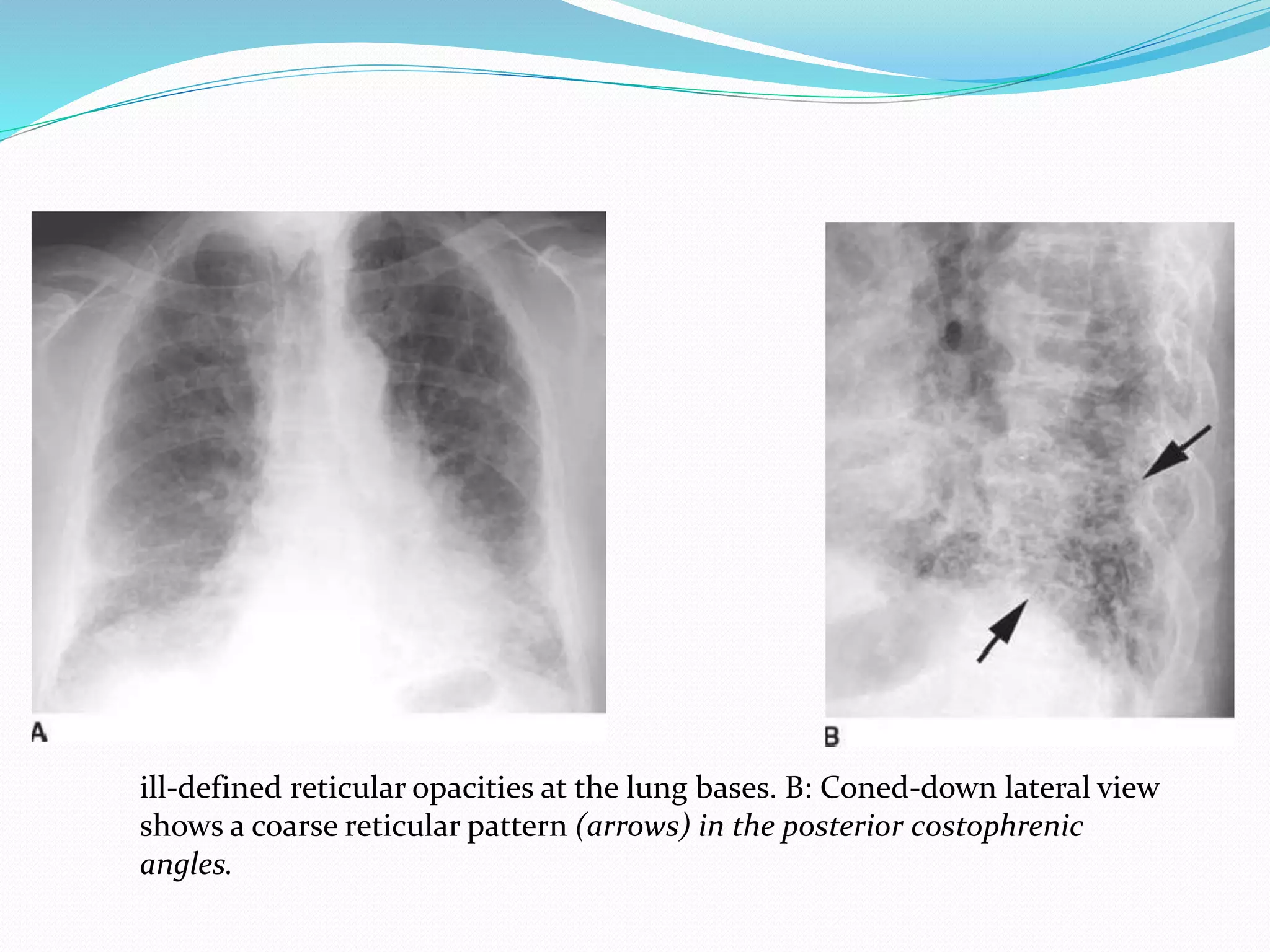 Hrct of idiopathic interstitial pneumonias | PPTX