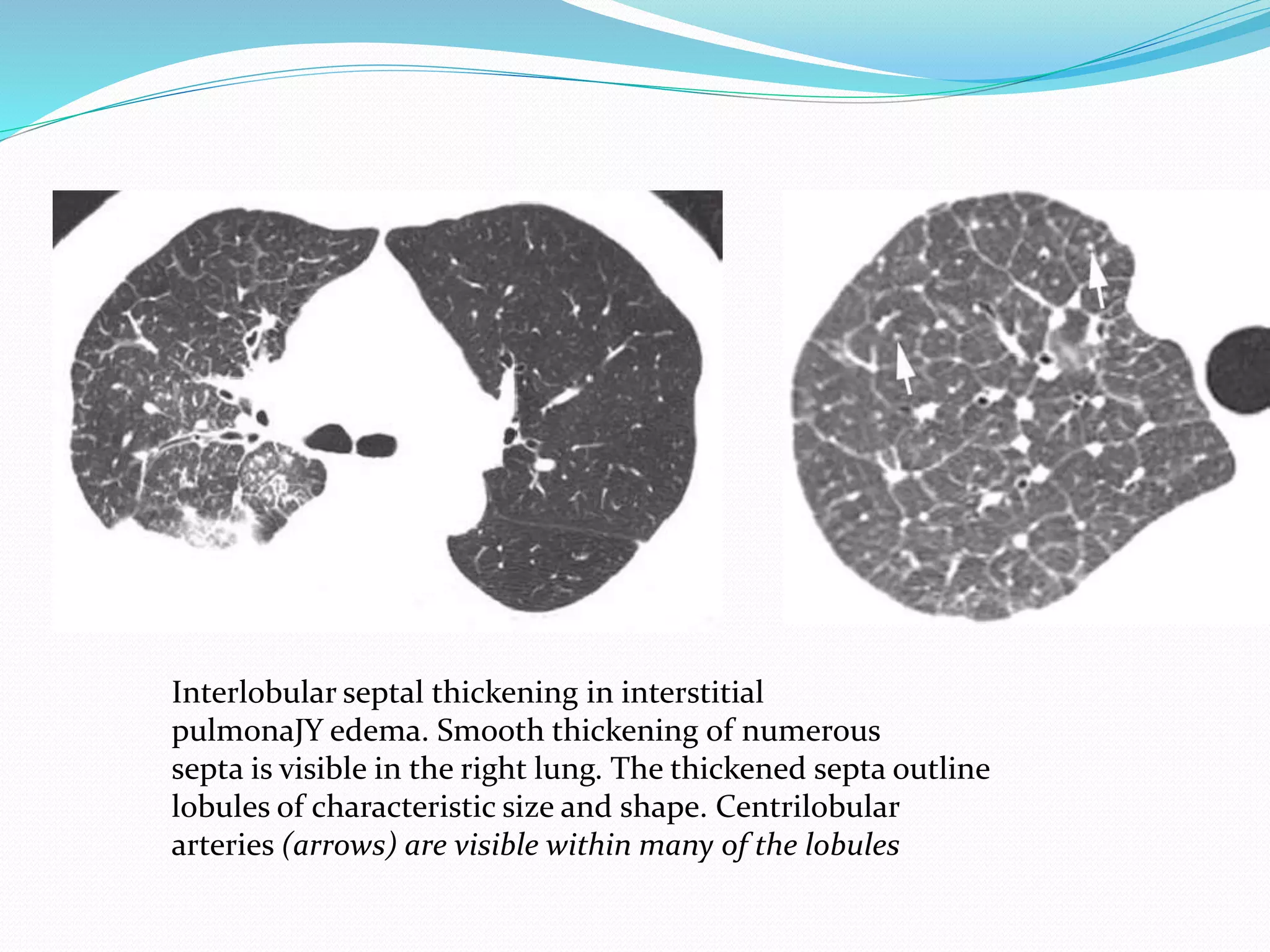 Hrct of idiopathic interstitial pneumonias | PPTX