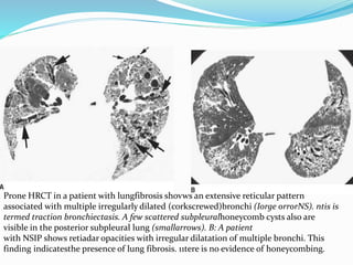 Hrct of idiopathic interstitial pneumonias | PPTX