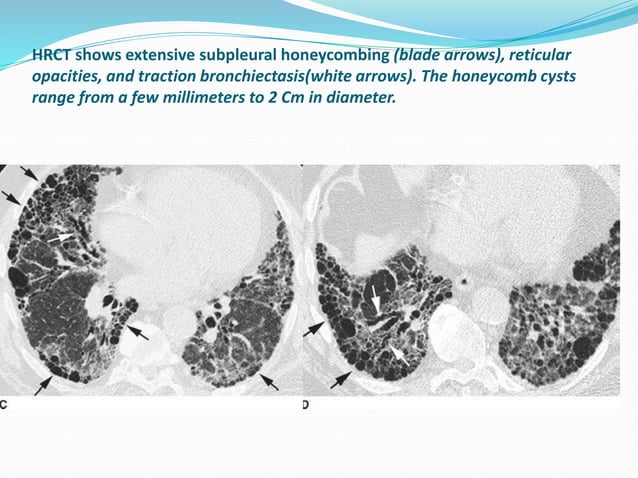 Hrct of idiopathic interstitial pneumonias | PPT
