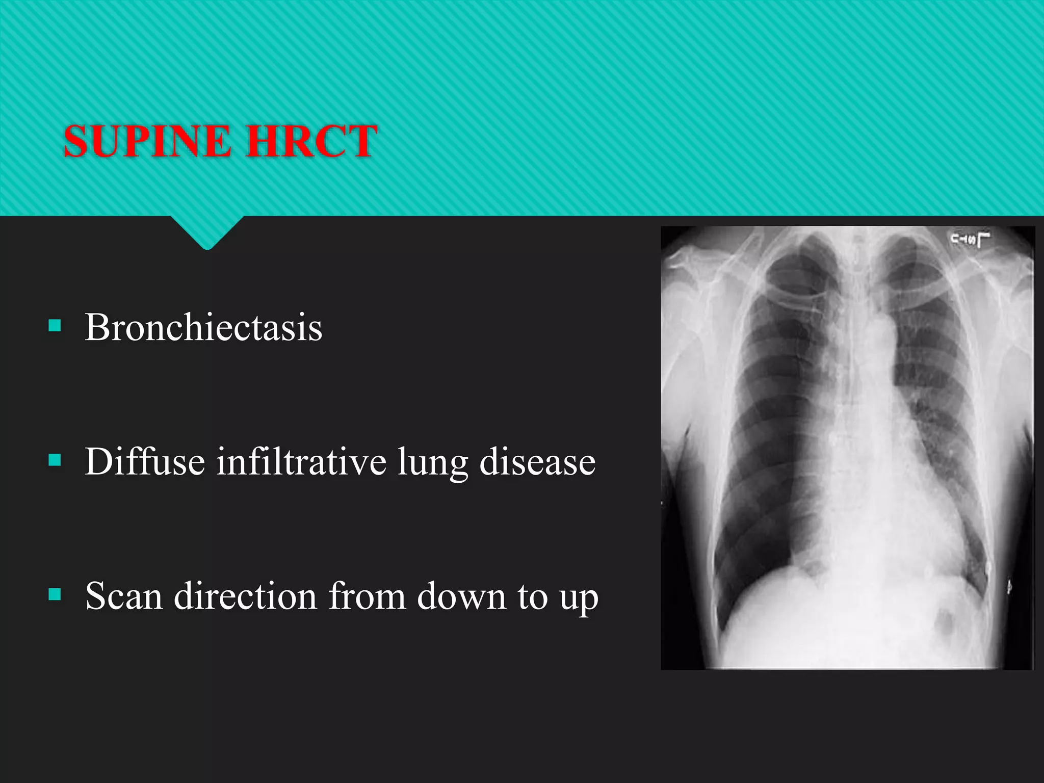 HRCT CHEST/TEMPORAL BONE PROTOCOL.pptx
