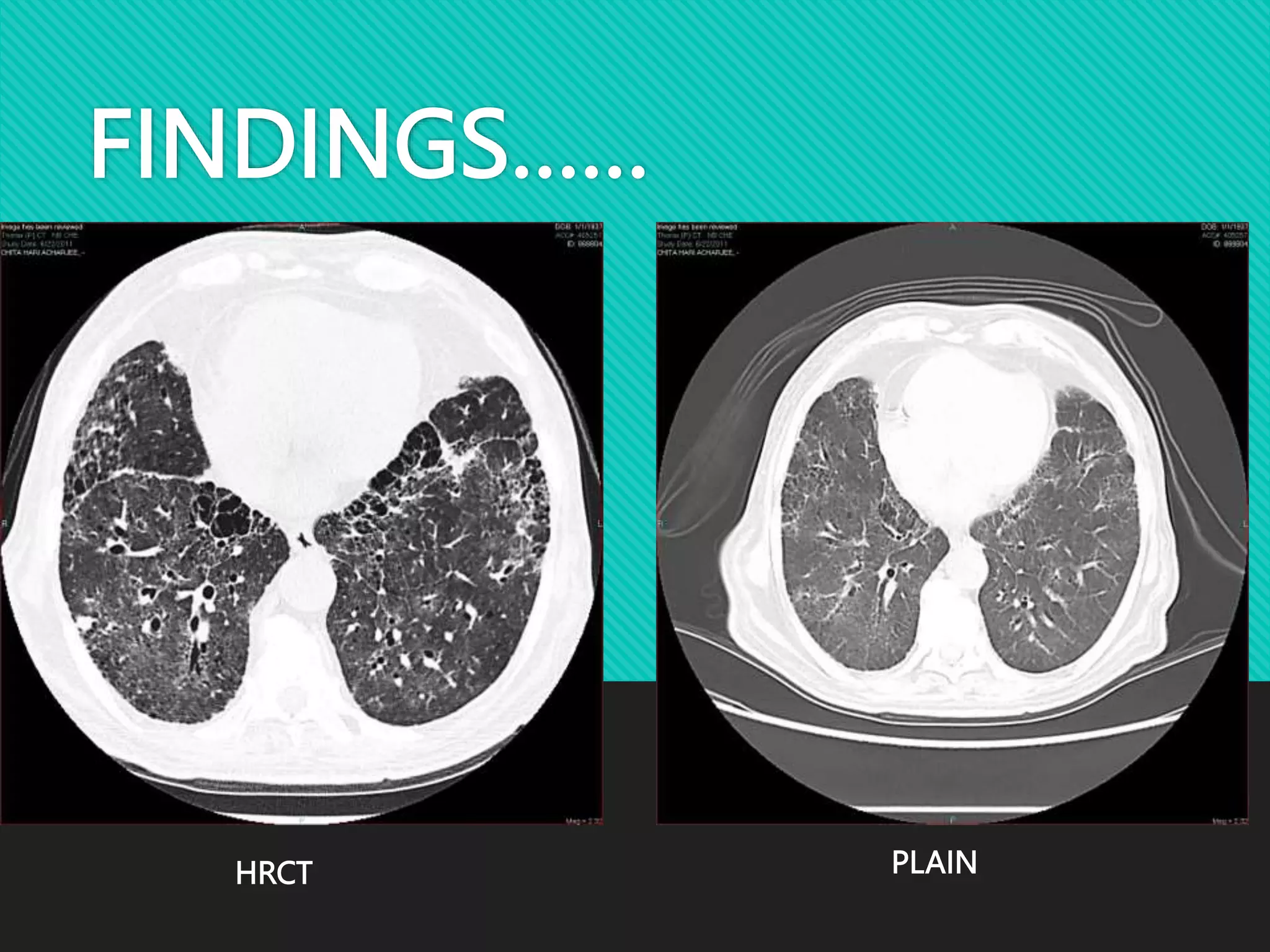 HRCT CHEST/TEMPORAL BONE PROTOCOL.pptx