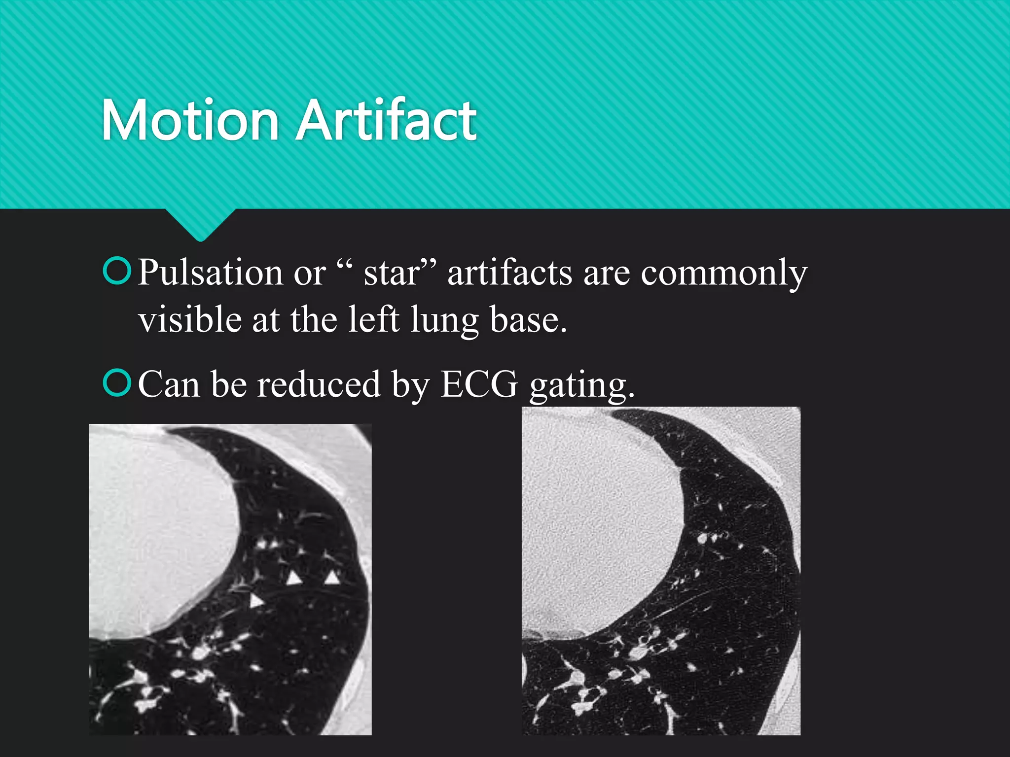 HRCT CHEST/TEMPORAL BONE PROTOCOL.pptx