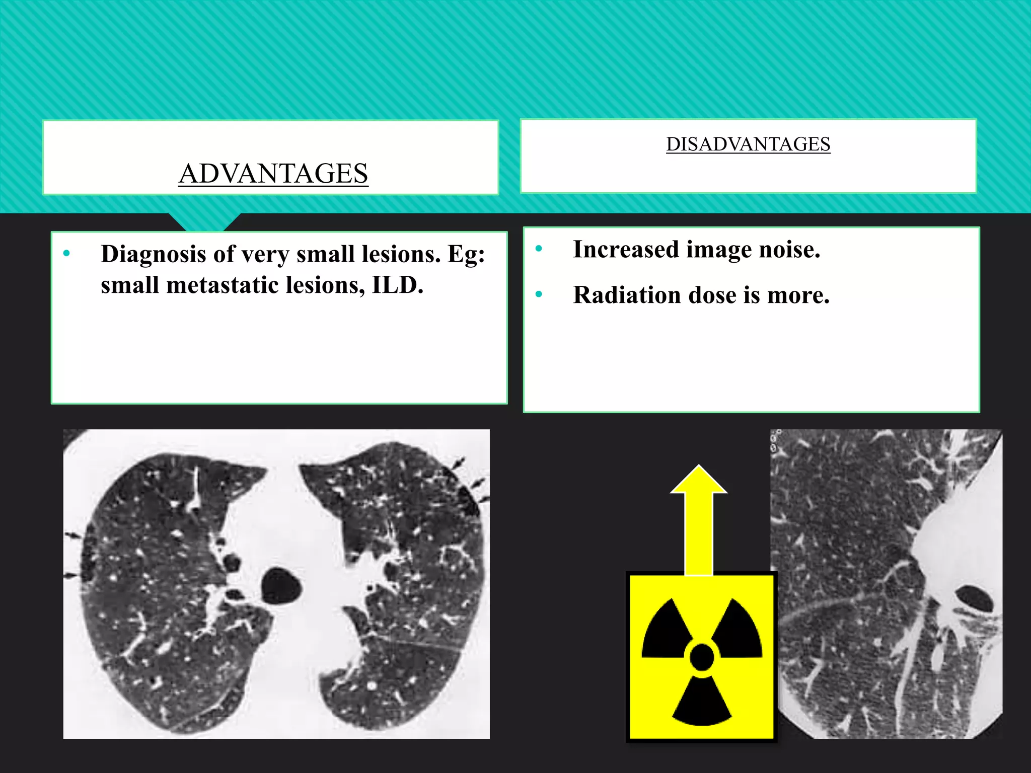 HRCT CHEST/TEMPORAL BONE PROTOCOL.pptx