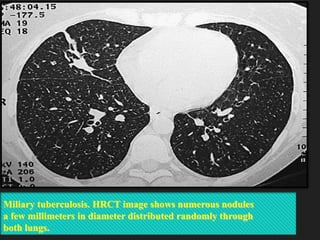 HRCT CHEST/TEMPORAL BONE PROTOCOL.pptx