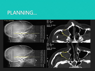HRCT CHEST/TEMPORAL BONE PROTOCOL.pptx