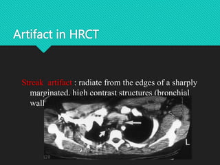 HRCT CHEST/TEMPORAL BONE PROTOCOL.pptx