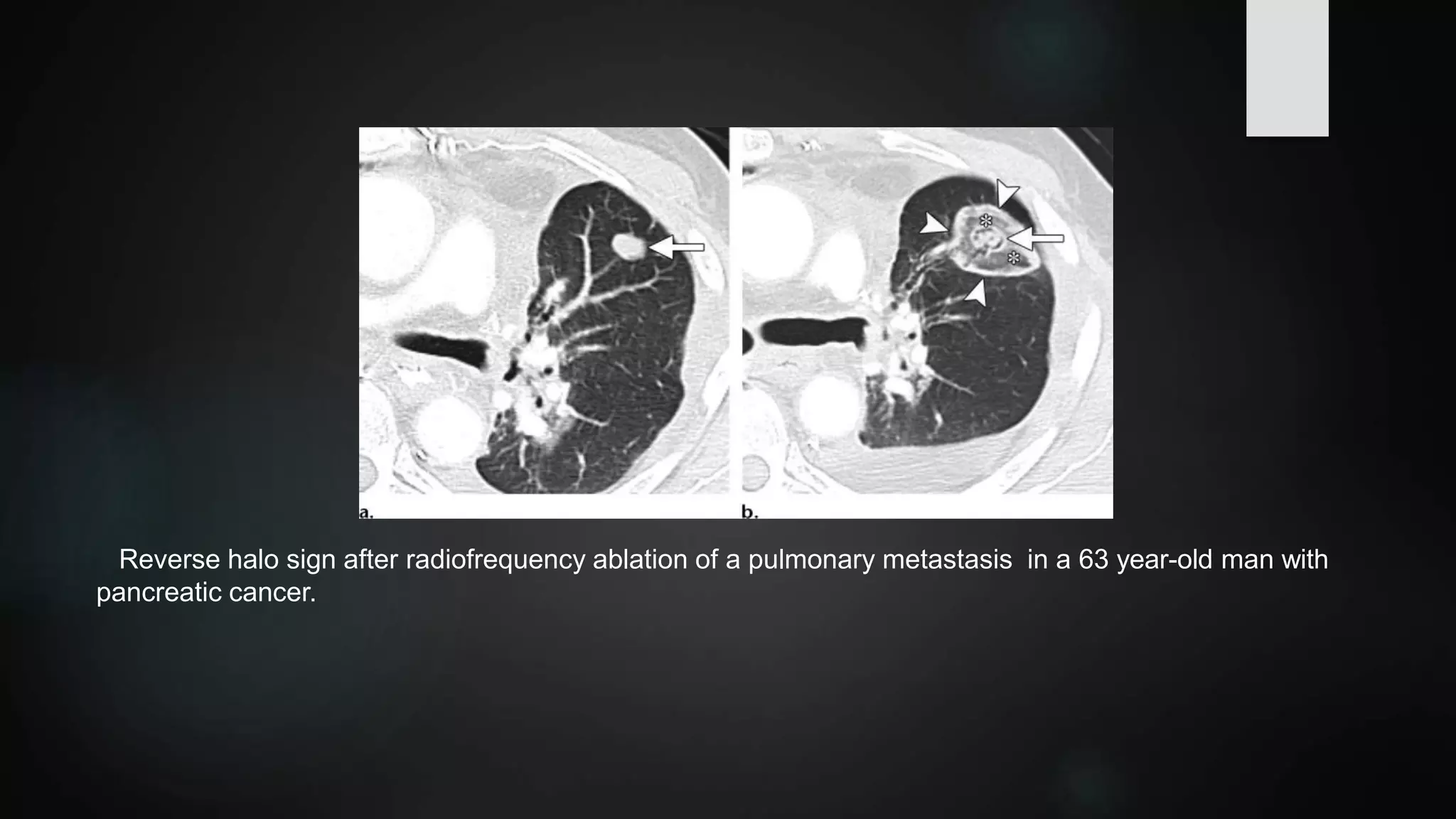 HRCT evaluation of nodular lung diseases and CT guided biopsy of nodular lung lesions | PPTX
