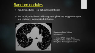 HRCT evaluation of nodular lung diseases and CT guided biopsy of ...