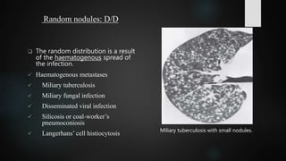 HRCT evaluation of nodular lung diseases and CT guided biopsy of ...