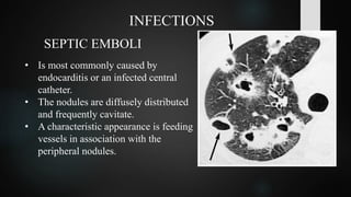 HRCT evaluation of nodular lung diseases and CT guided biopsy of ...