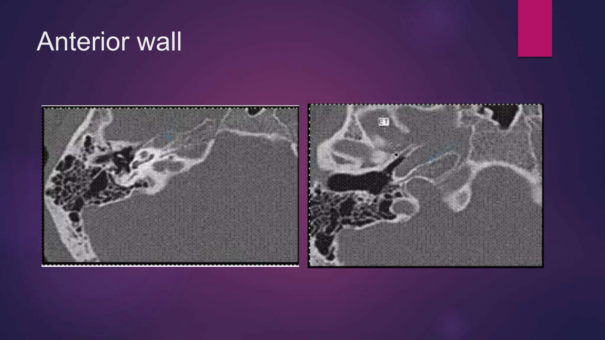High Resolution Computer TomographyTEMPORAL BONE Pathology.pptx