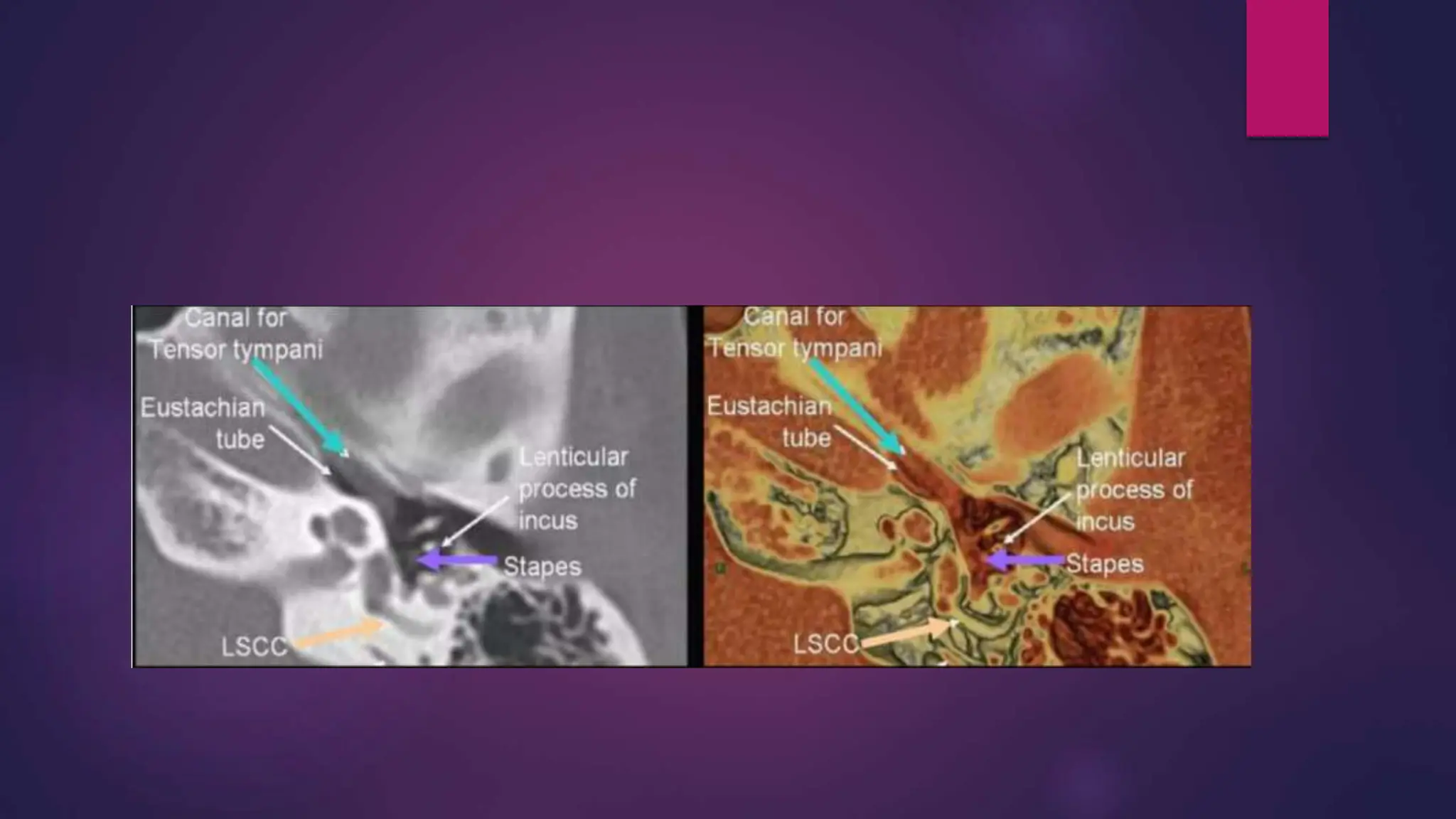 High Resolution Computer TomographyTEMPORAL BONE Pathology.pptx