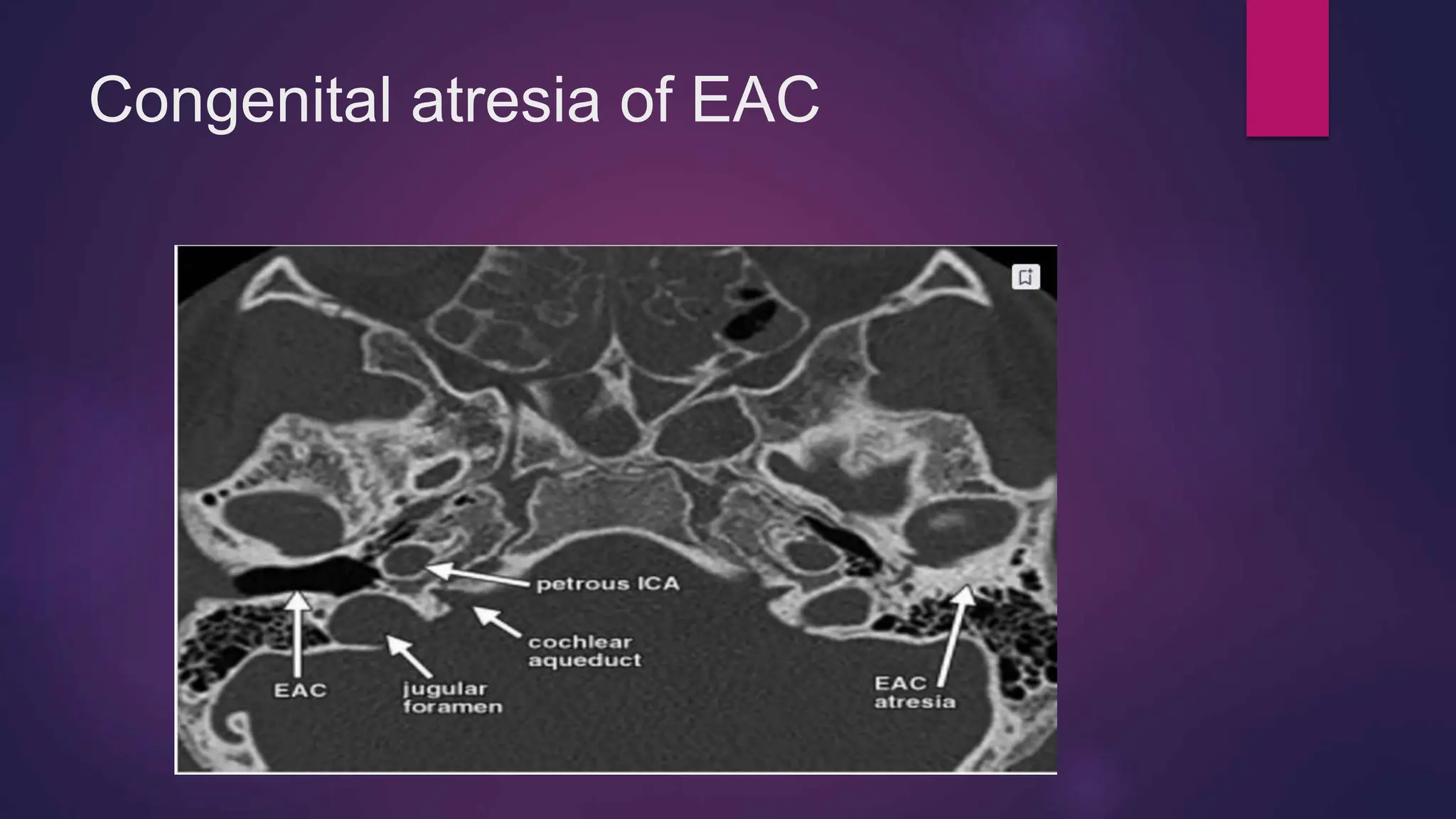 High Resolution Computer TomographyTEMPORAL BONE Pathology.pptx