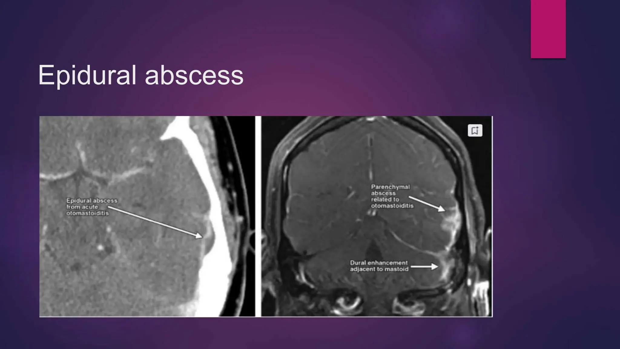High Resolution Computer TomographyTEMPORAL BONE Pathology.pptx