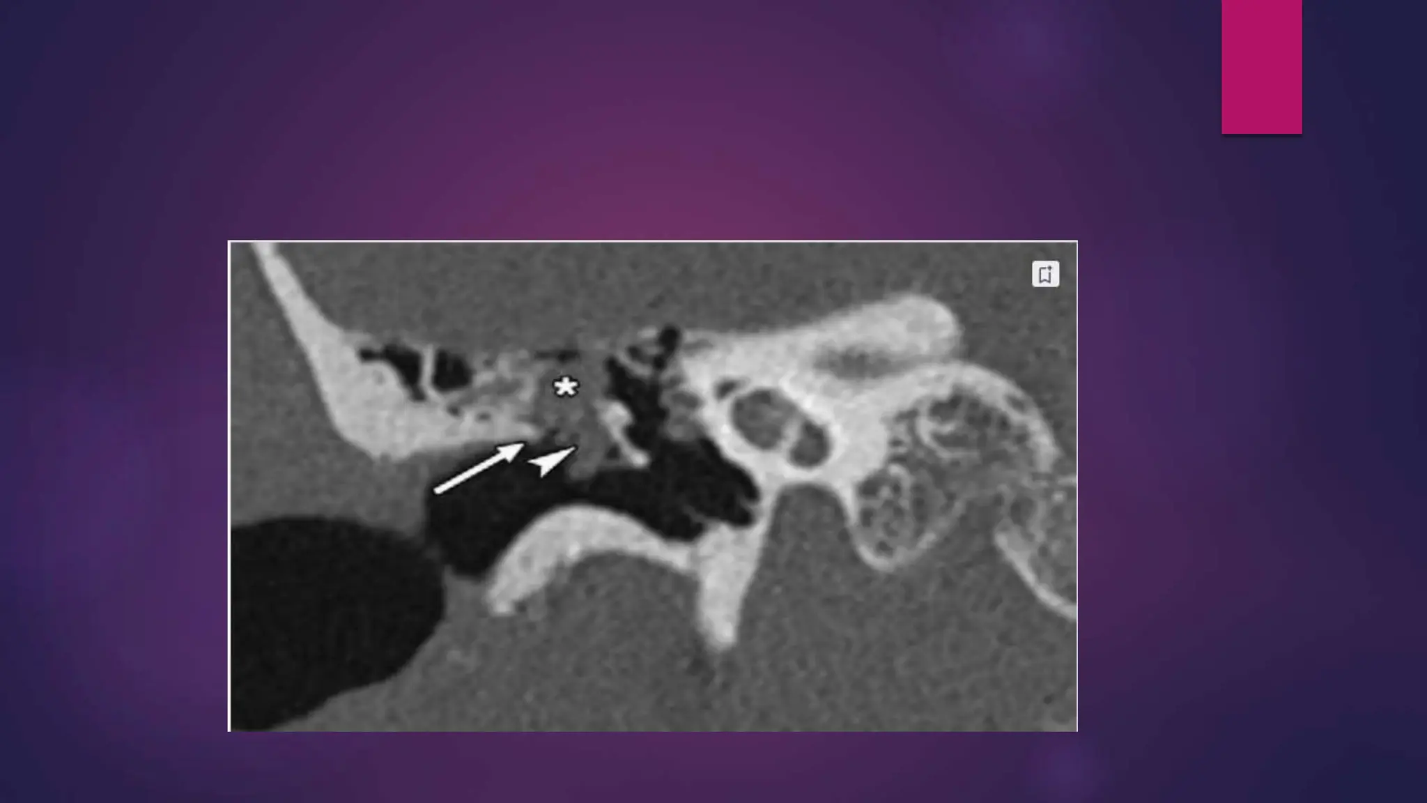 High Resolution Computer TomographyTEMPORAL BONE Pathology.pptx