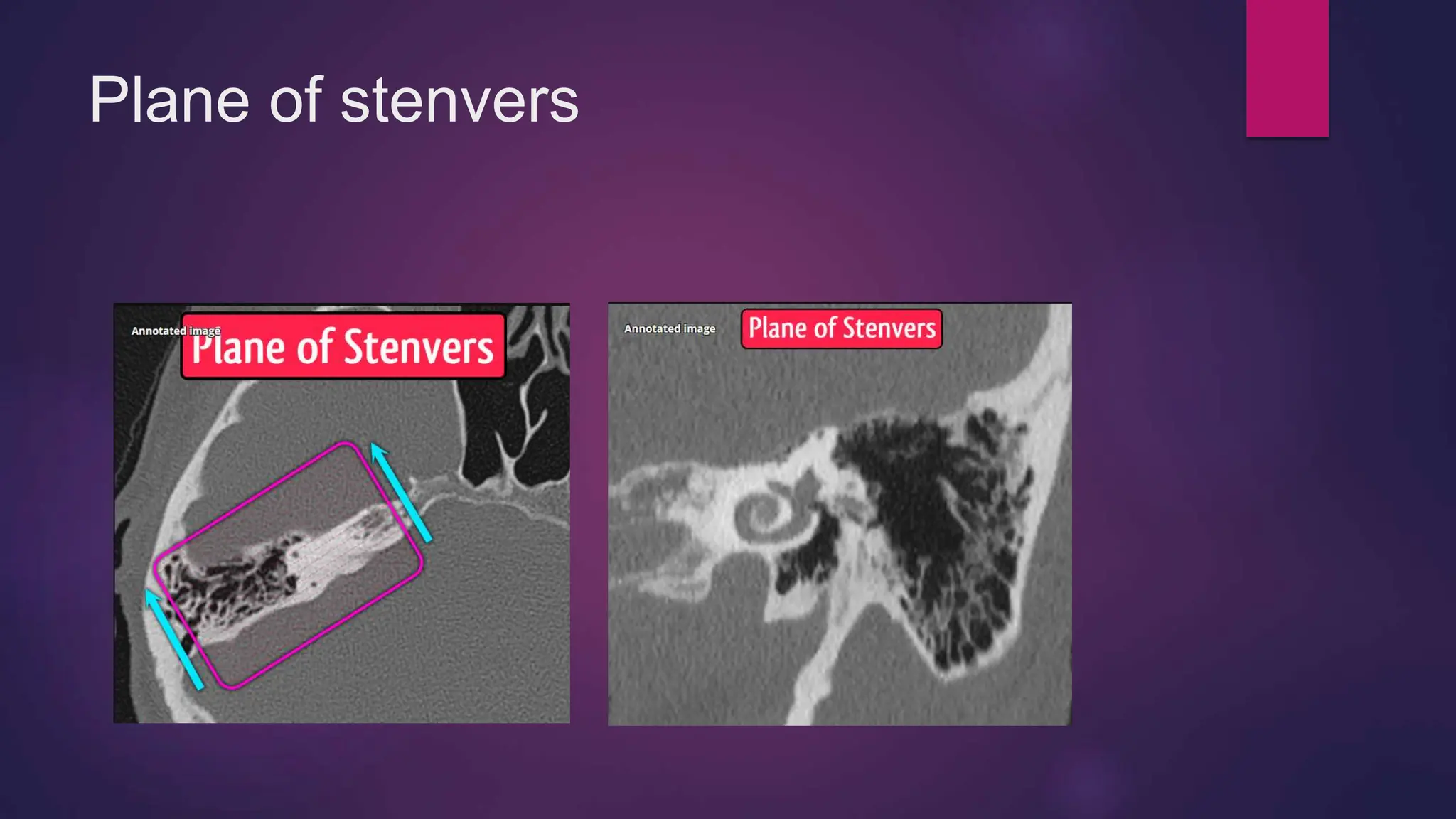 High Resolution Computer TomographyTEMPORAL BONE Pathology.pptx