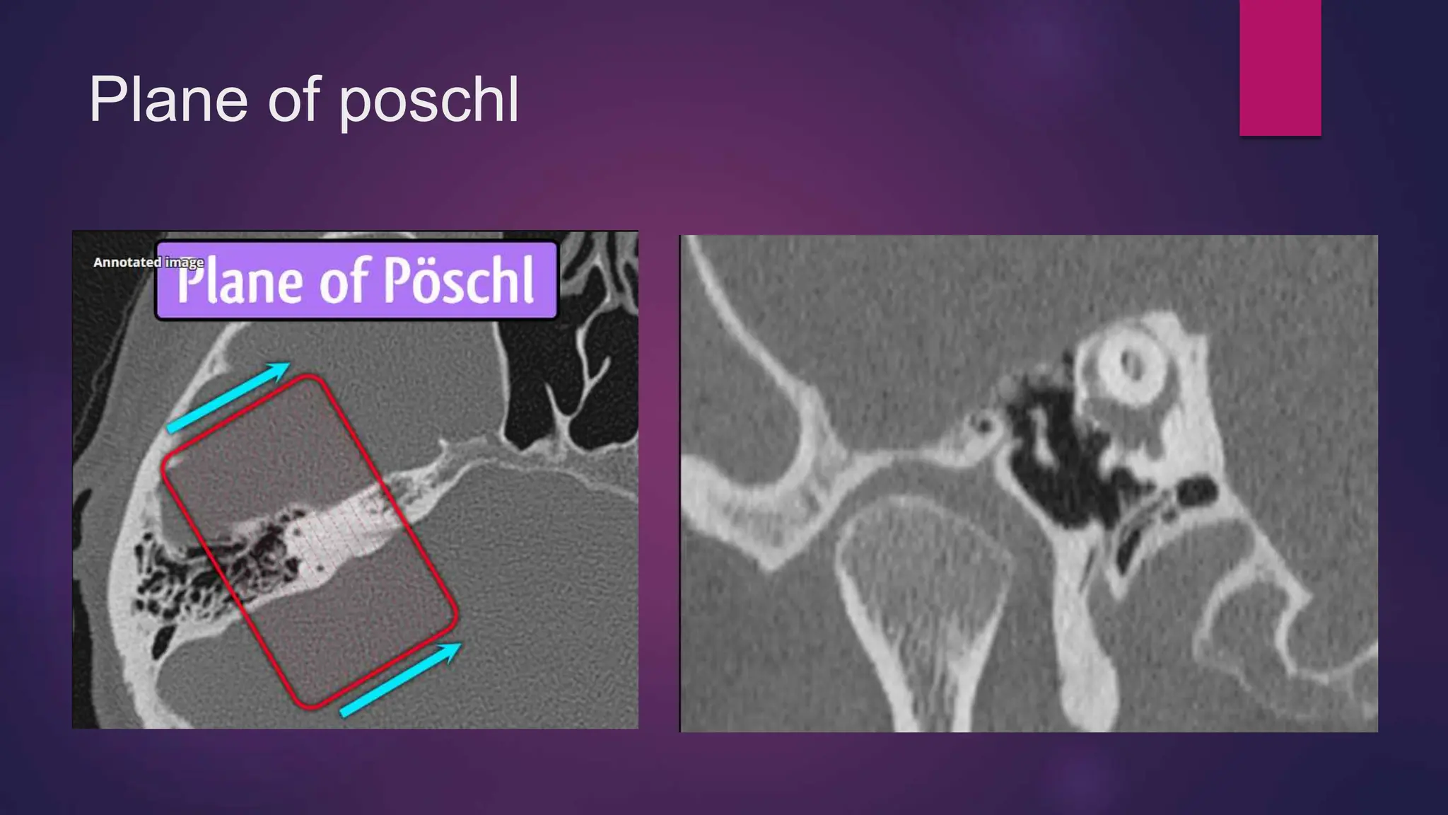 High Resolution Computer TomographyTEMPORAL BONE Pathology.pptx
